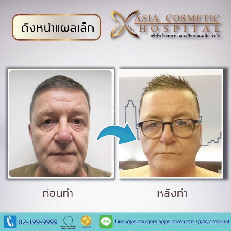 Face lift