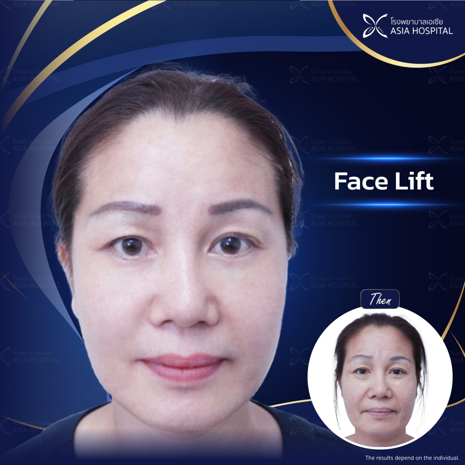 Face lift