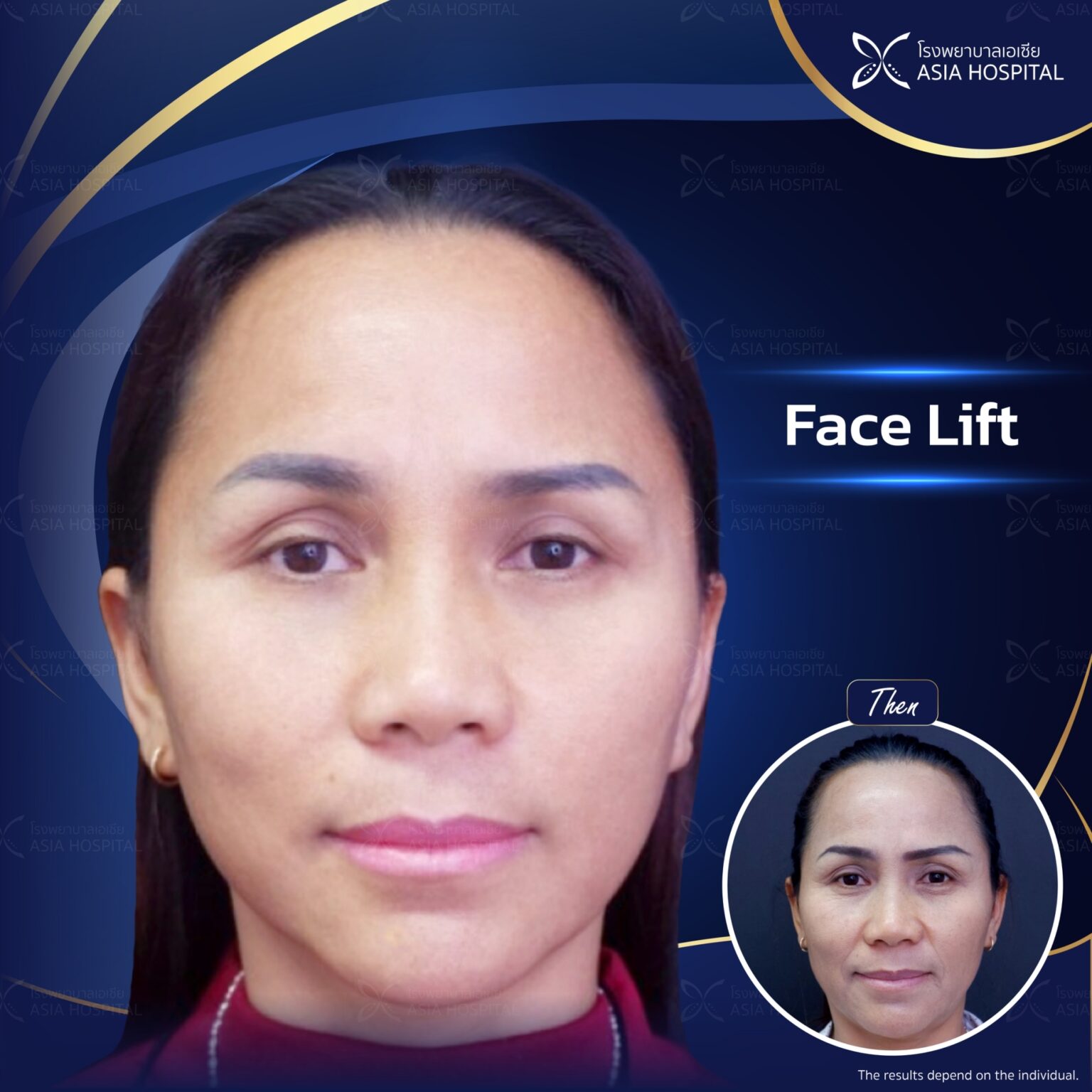 Face lift