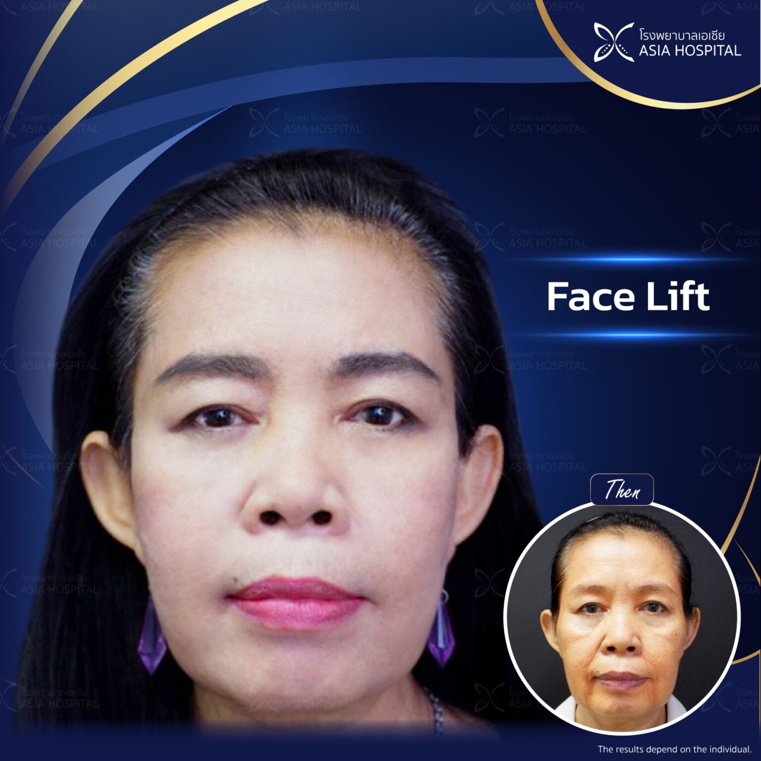 Face lift