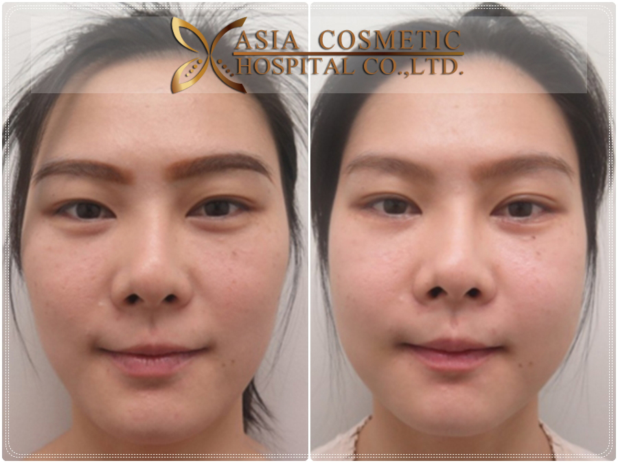 Jaw Reduction Surgery