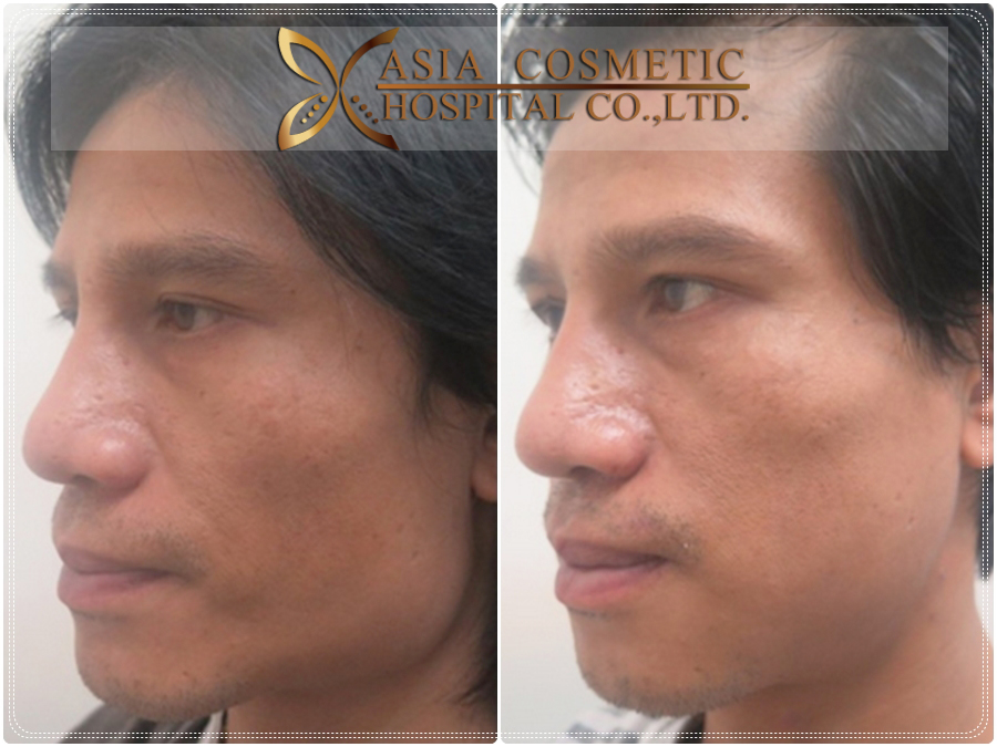 Jaw Reduction Surgery