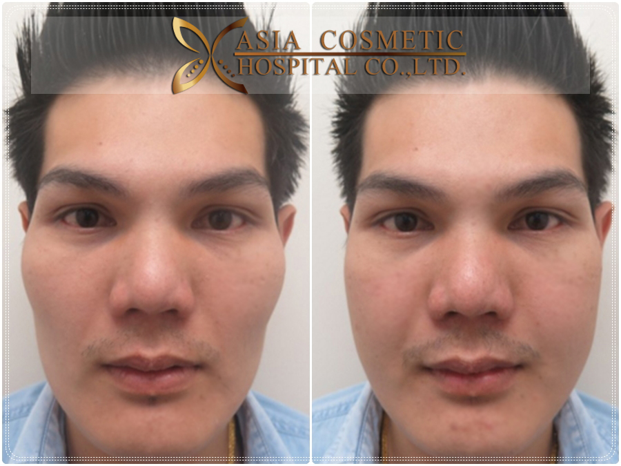 Jaw Reduction Surgery