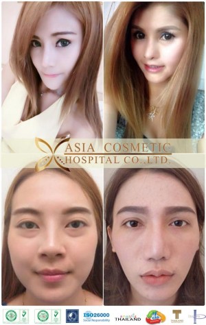 Cheekbone Reduction Before and After