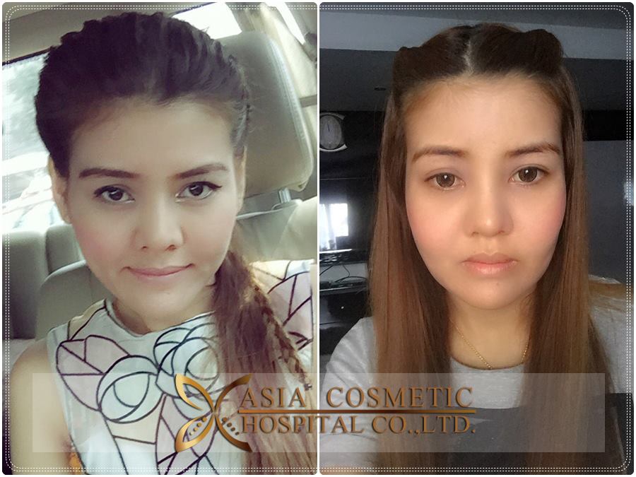 Cheekbone Reduction Before and After