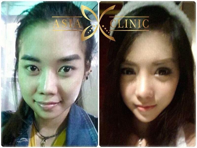 V line Thailand - V Shape Face