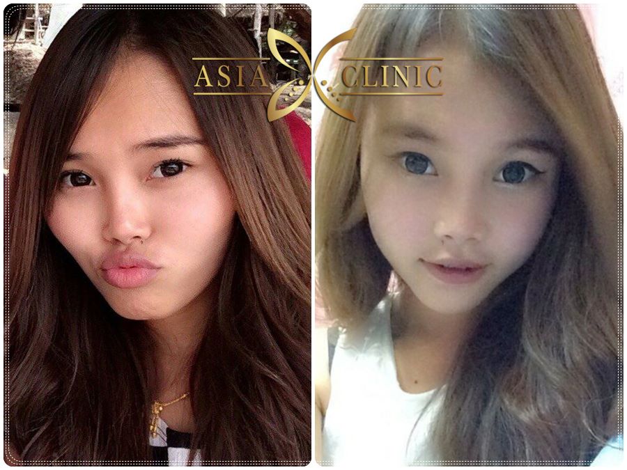 Cheekbone Reduction Before and After